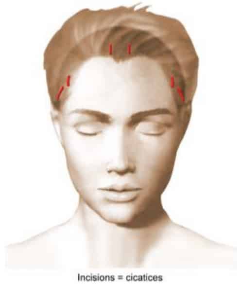 Lifting frontal Paris - Dr Ralph ABBOU Lifting frontal Paris - Dr Ralph ABBOU