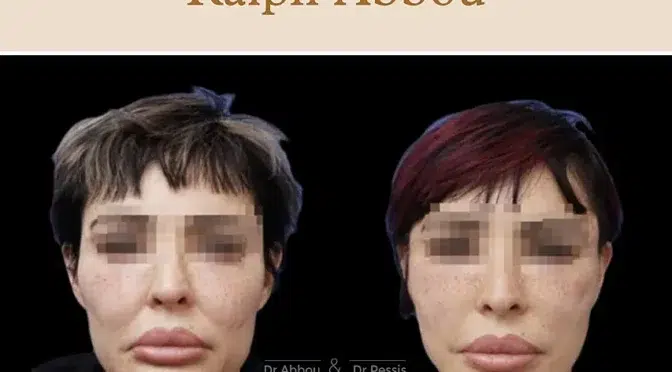 Sillon naso genien, comment combler avec acide hyaluronique