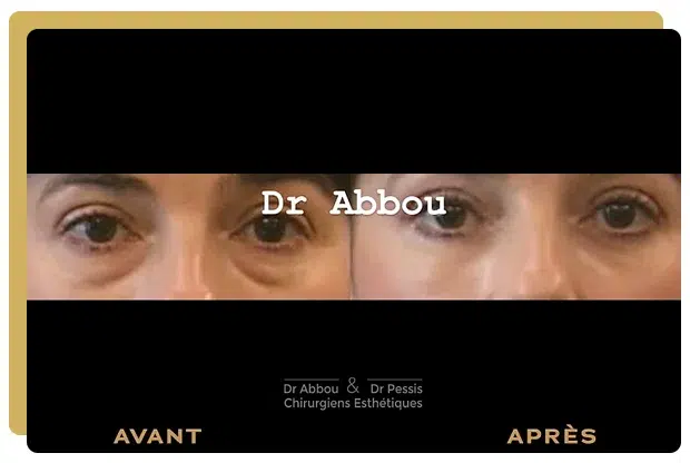 Traitement des poches sous les yeux. Dr Ralph ABBOU Traitement des poches sous les yeux. Dr Ralph ABBOU