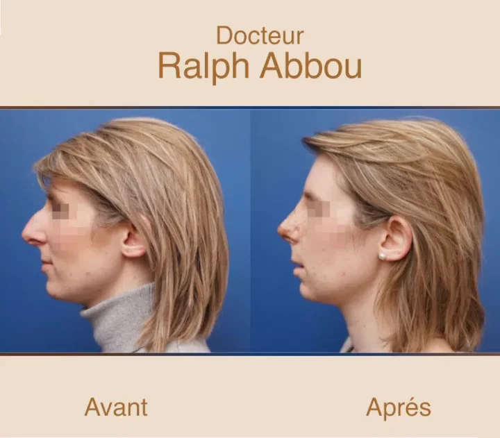 Rhinoplastie ultrasonique : rhinoplastie sans plâtre et sans mèches