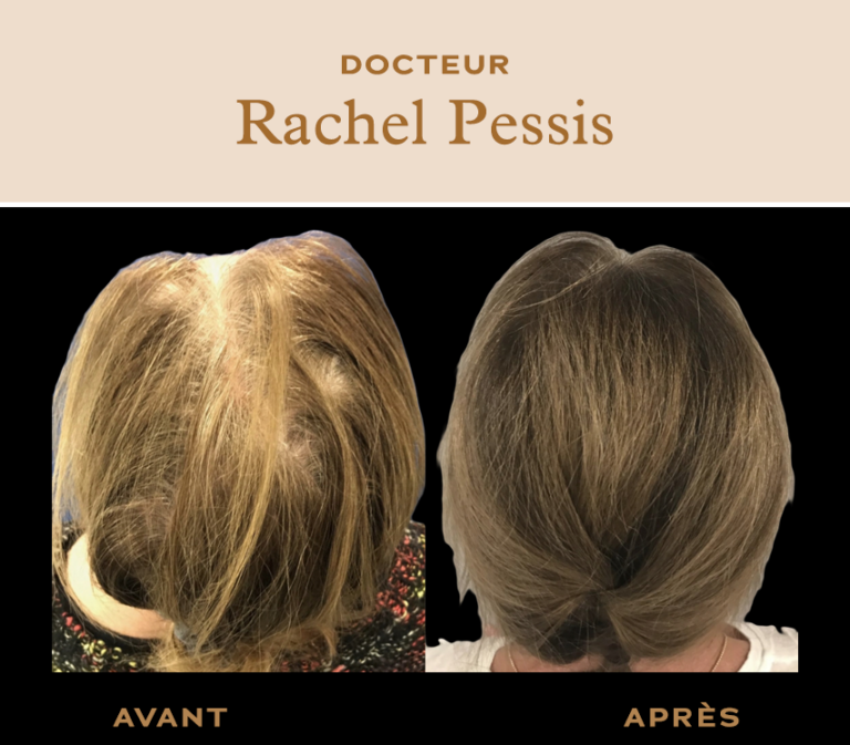 Perte de cheveux chez la femme : les traitements