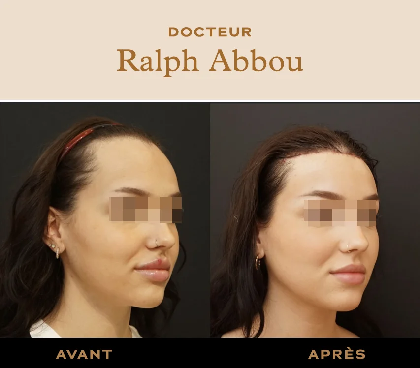 Avant / Après : Abaissement de la ligne frontale - Dr Abbou