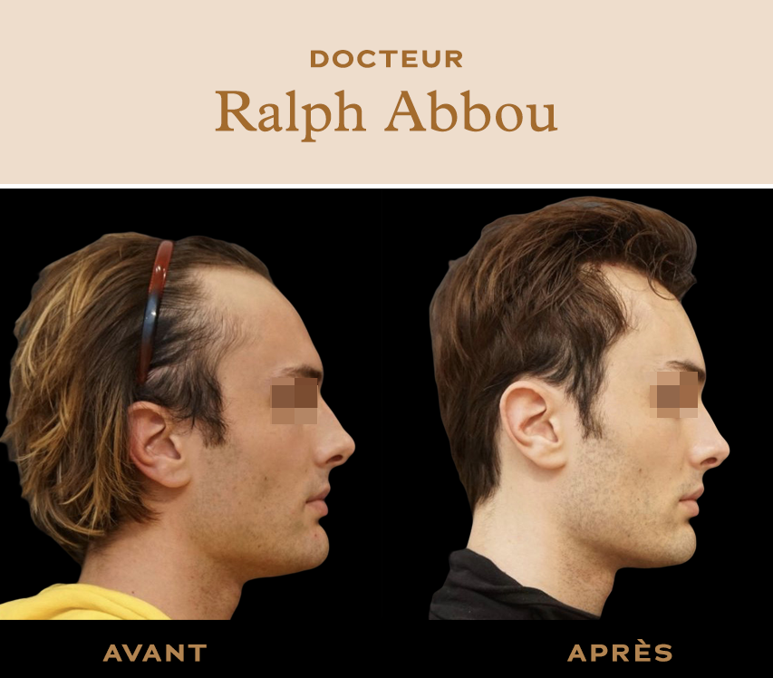 Avant / Après : Abaissement de la ligne frontale - Dr Abbou