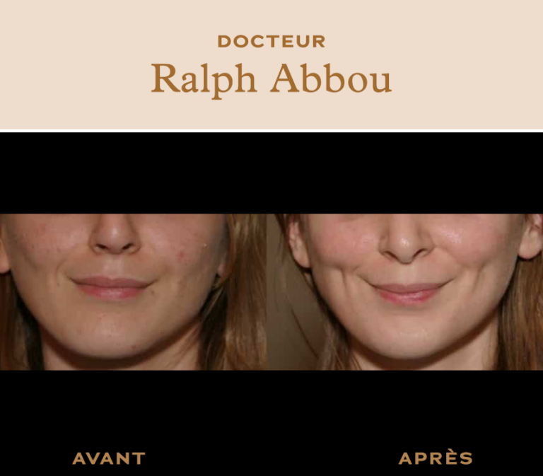 Dimpleplasty Paris - Dr Ralph Abbou