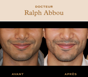 Chirurgie des fossettes à Paris. Dimpleplasty Dr Ralph Abbou