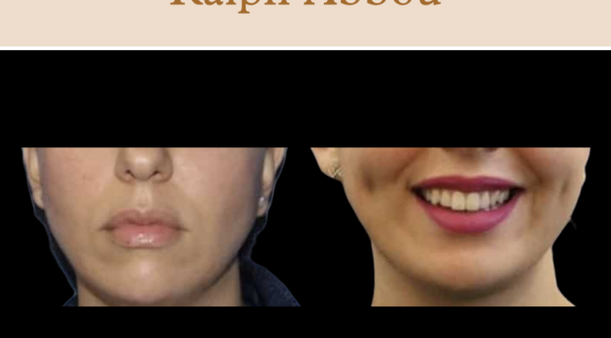 Chirurgie des fossettes à Paris. Dimpleplasty Dr Ralph Abbou