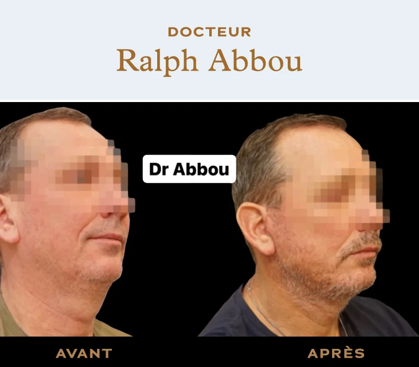 Facelift Paris - Dr Ralph Abbou cosmetic surgeon