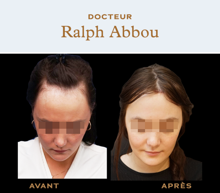 Forehead reduction surgery Paris. Dr Ralph ABBOU