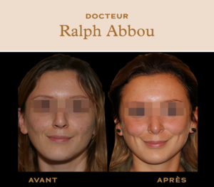 Chirurgie des fossettes à Paris. Dimpleplasty Dr Ralph Abbou