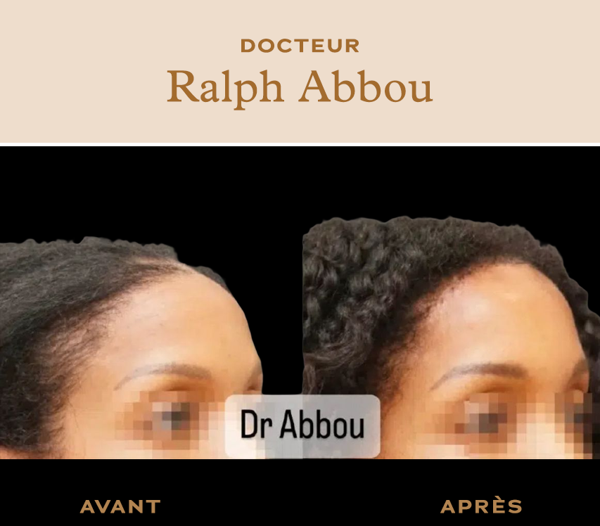 greffe de cheveux paris. Technique FUE et FUT Dr Ralph ABBOU greffe de cheveux paris. Technique FUE et FUT Dr Ralph ABBOU