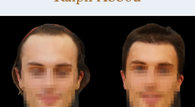 Before after Forehead reduction surgery paris - Dr Ralph Abbou